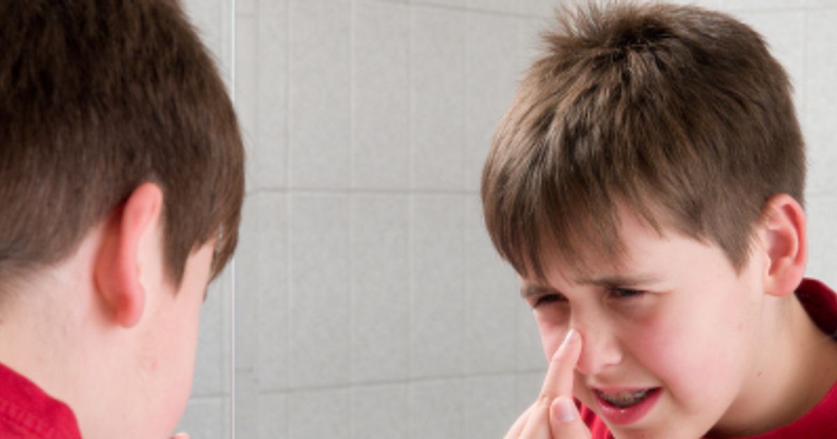 Can kids get acne? - Today's Parent