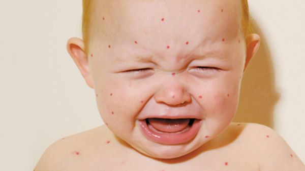 What you need to know about the chicken pox vaccine - Today's Parent