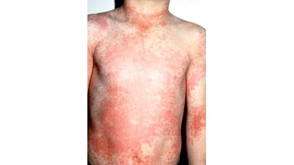 10 common rashes on kids (with photos) - Today's Parent