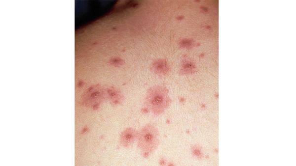 10 common rashes on kids (with photos) - Today's Parent