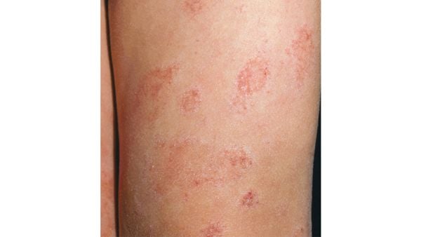 10 common rashes on kids (with photos) - Today's Parent