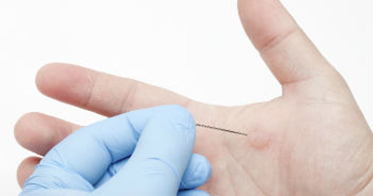 How to treat a blister - Today's Parent