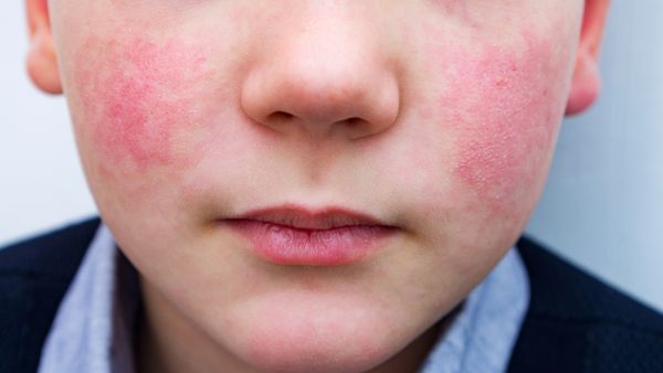 5 most common kid skin rashes and sensitivities (and how to soothe them ...