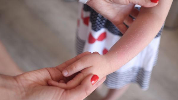 5 most common kid skin rashes and sensitivities (and how to soothe them ...