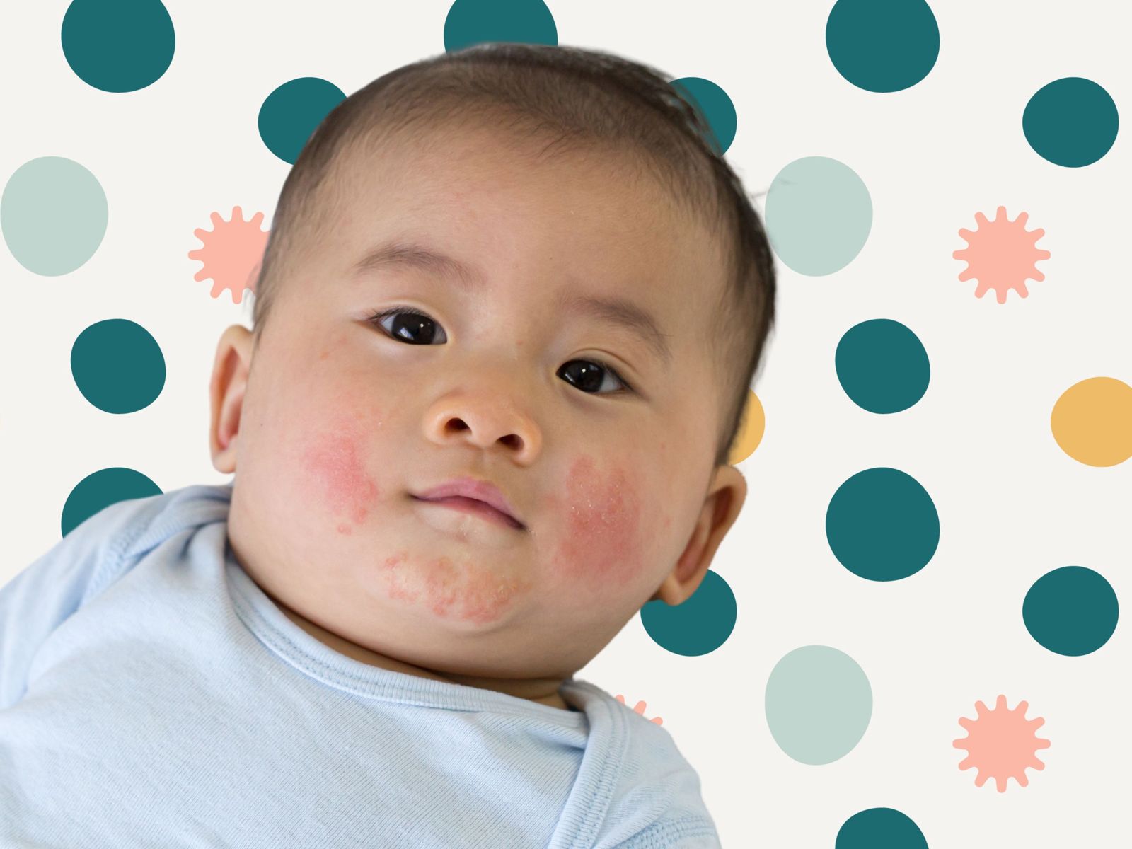 Fever Rash In Toddlers Rashes In Babies And Children NHS