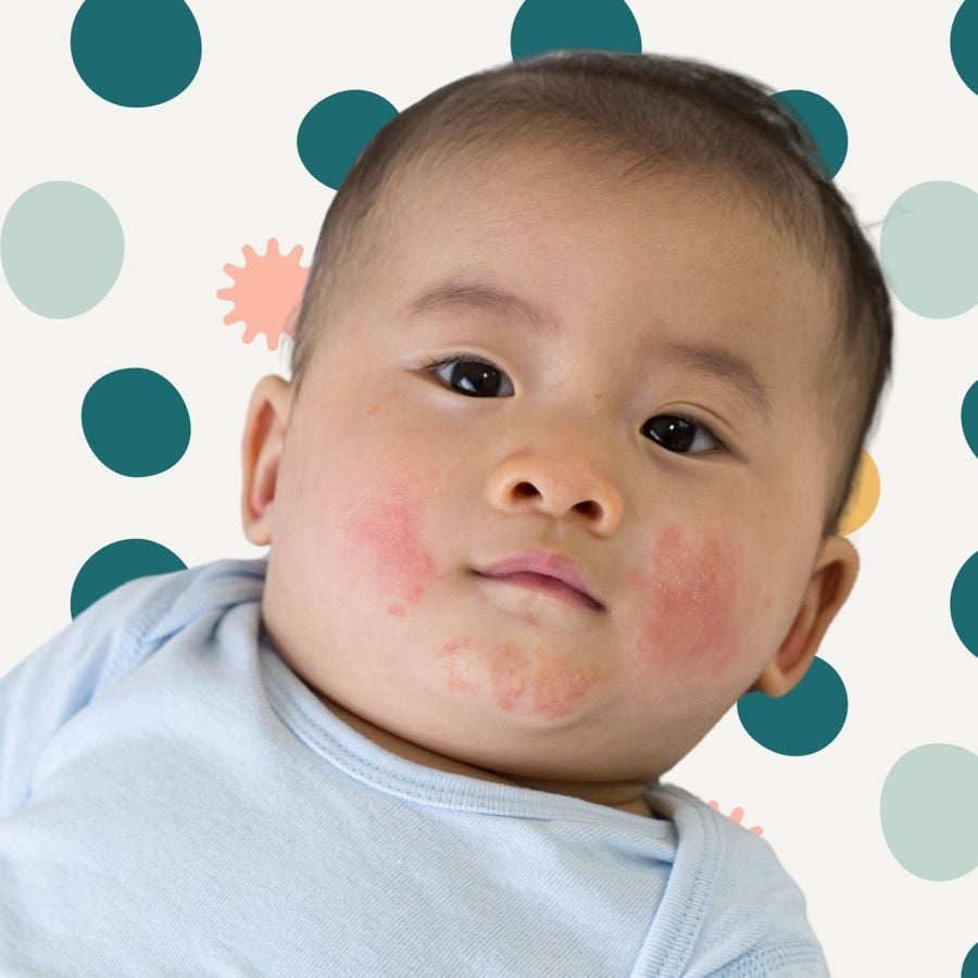Roseola Rash On Cheek Red Spots And Rashes Caused By Viruses Online