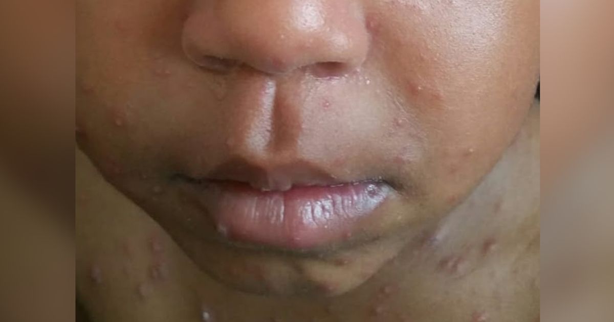Here's what kids' rashes look like on darker skin (finally!) - Today's ...