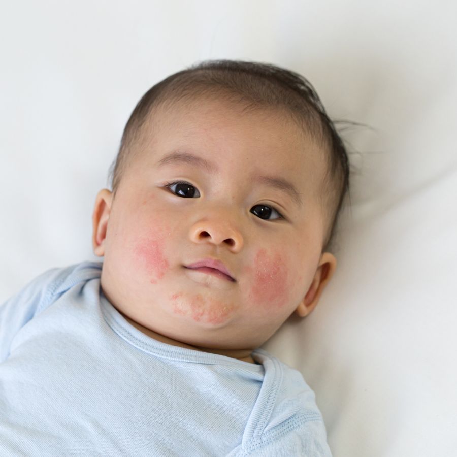 Small Red Spots Around Mouth Child Infoupdate Small Red Spots Around Mouth Child Infoupdate